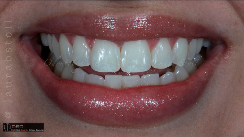 Dra. Laura Stoll - Restaurações estéticas de resina composta